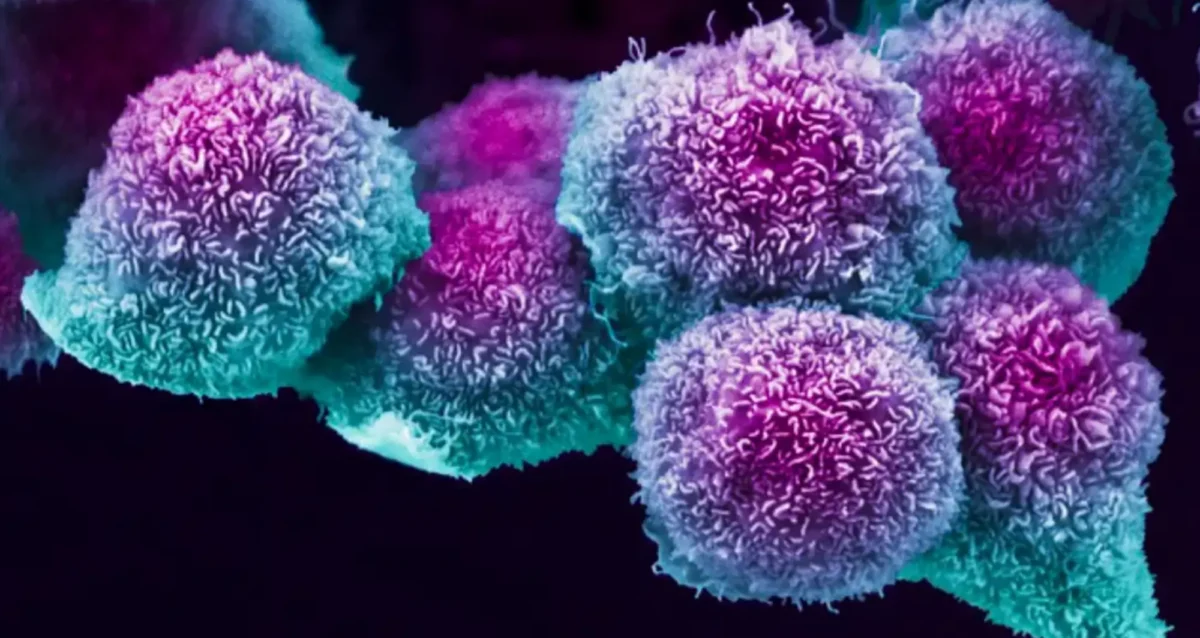 Science 101: Pancreatic cancer - Sanford Burnham Prebys